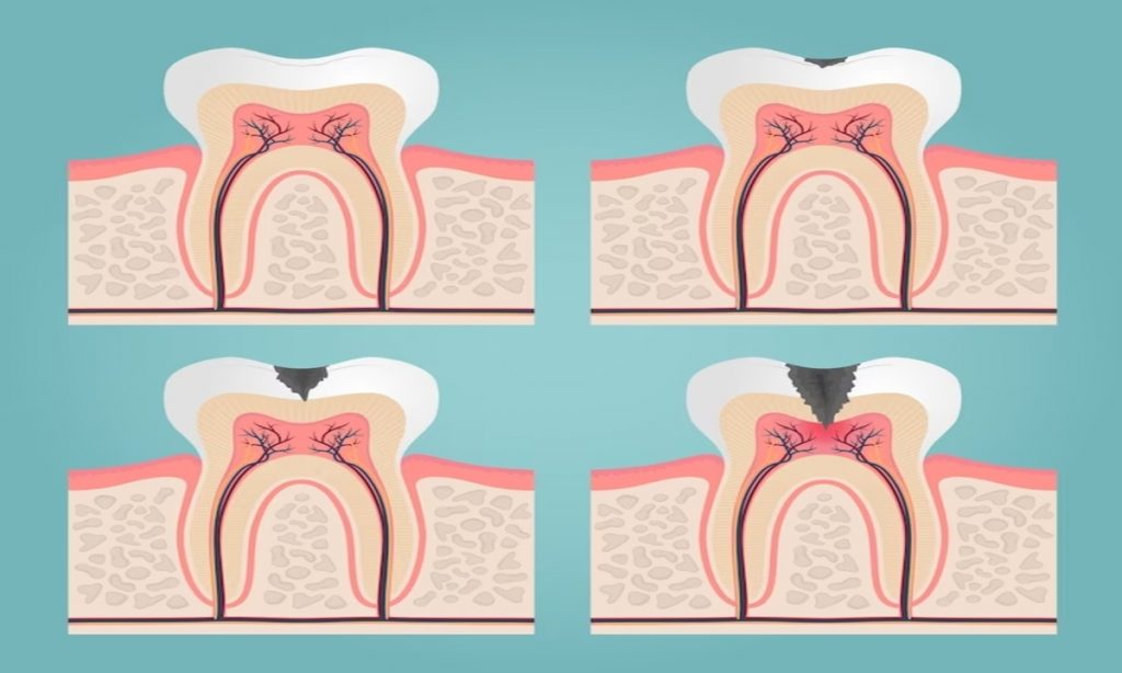 ¿Qué son las caries y cómo prevenirlas? - MediLife Medicina Pre-paga